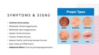 Acne, secretory glands and epithelia (1).pptx