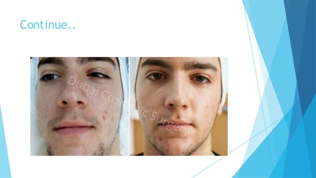 Acne Treatment In Dubai And Abu Dhabi