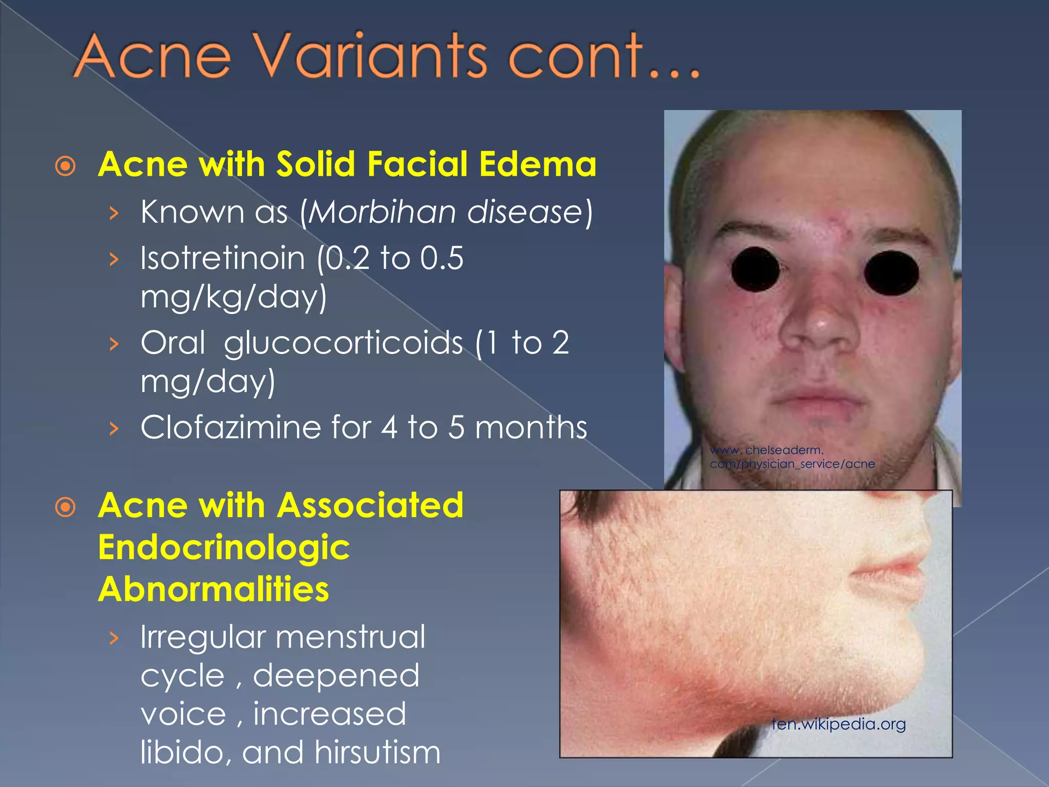 Acne Vulgaris | PPTX