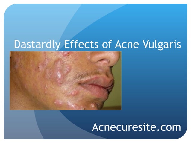 Dastardly Effects of Acne vulgaris | PPT
