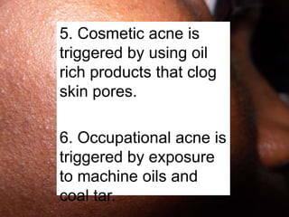 Acne vulgaris | PPT