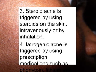 Acne vulgaris | PPT
