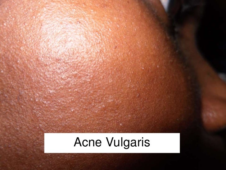 Acne vulgaris