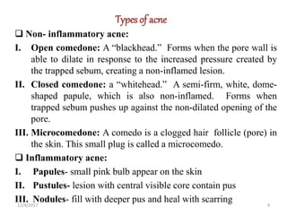 Acne vulgaris | PPT