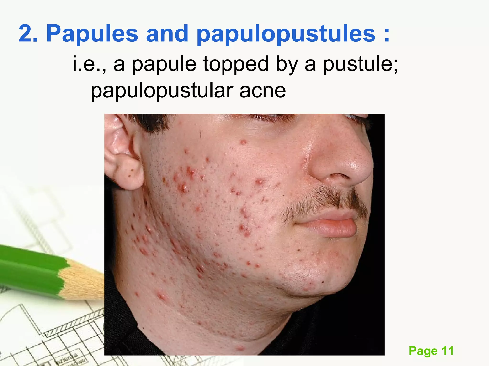 Acne vulgaris | PPT