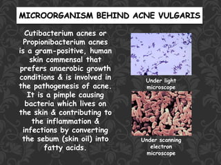 Acne vulgaris | PDF