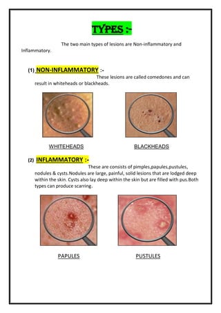 Acne vulgaris | PDF