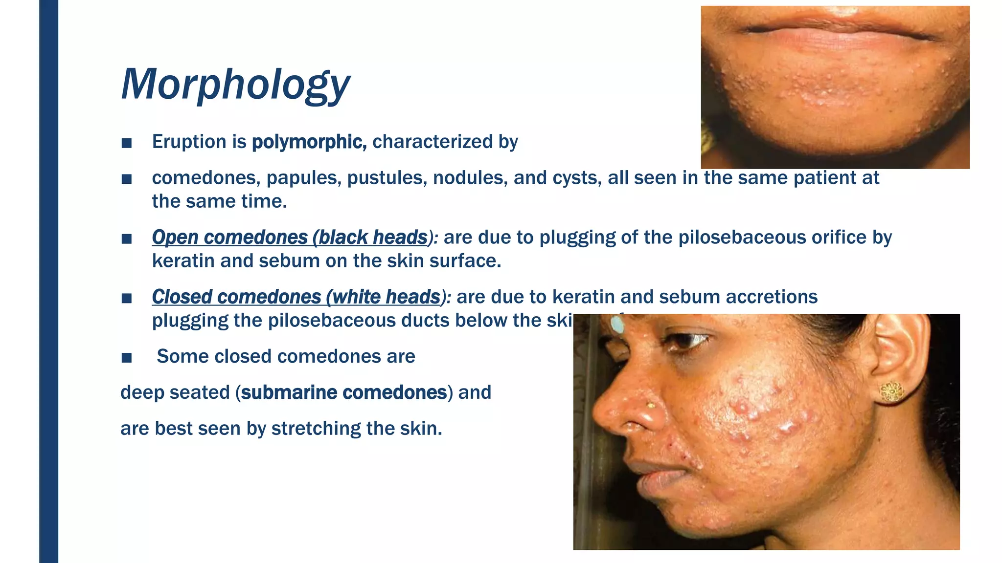 Acne vulgaris | PPTX