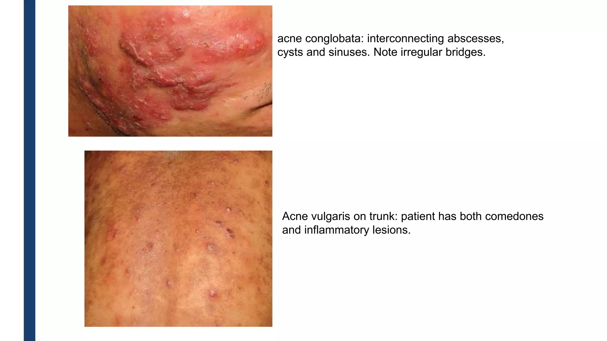 Acne vulgaris | PPTX