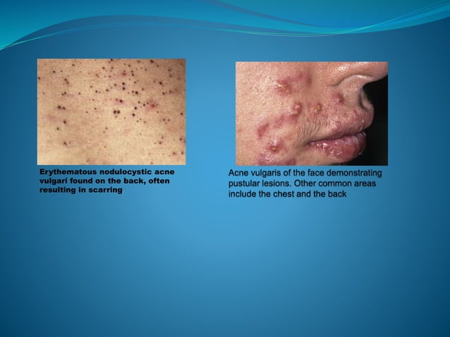 Acne vulgaris | PPT