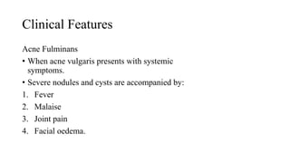 Acne Vulgaris | PPTX
