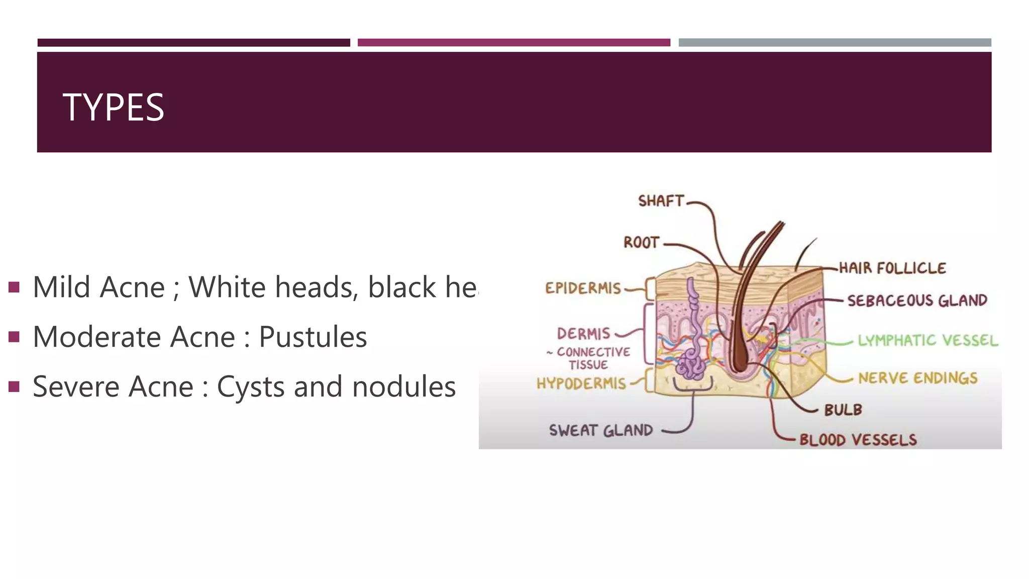 ACNE VULGARIS | PPTX