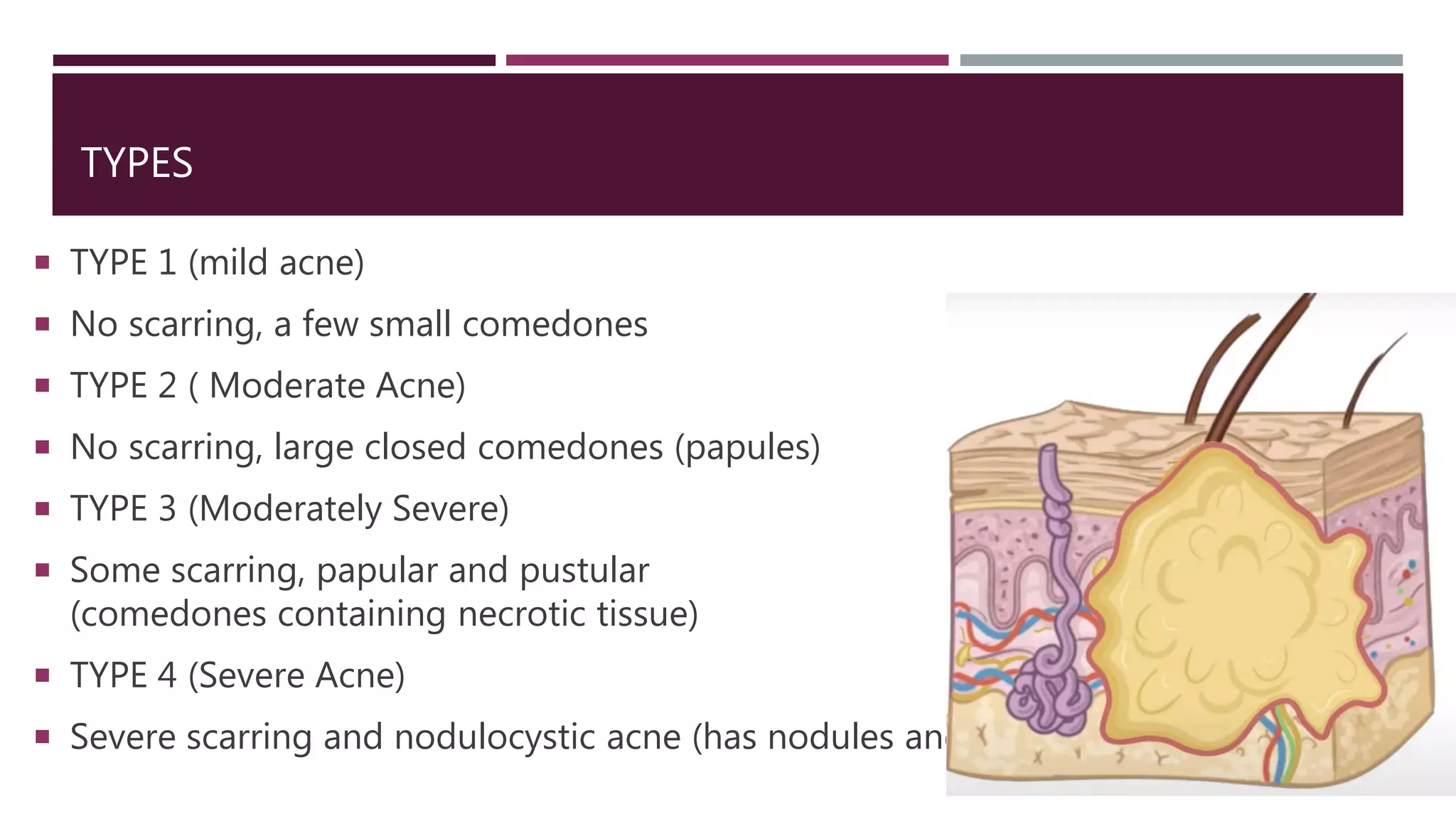 ACNE VULGARIS | PPTX