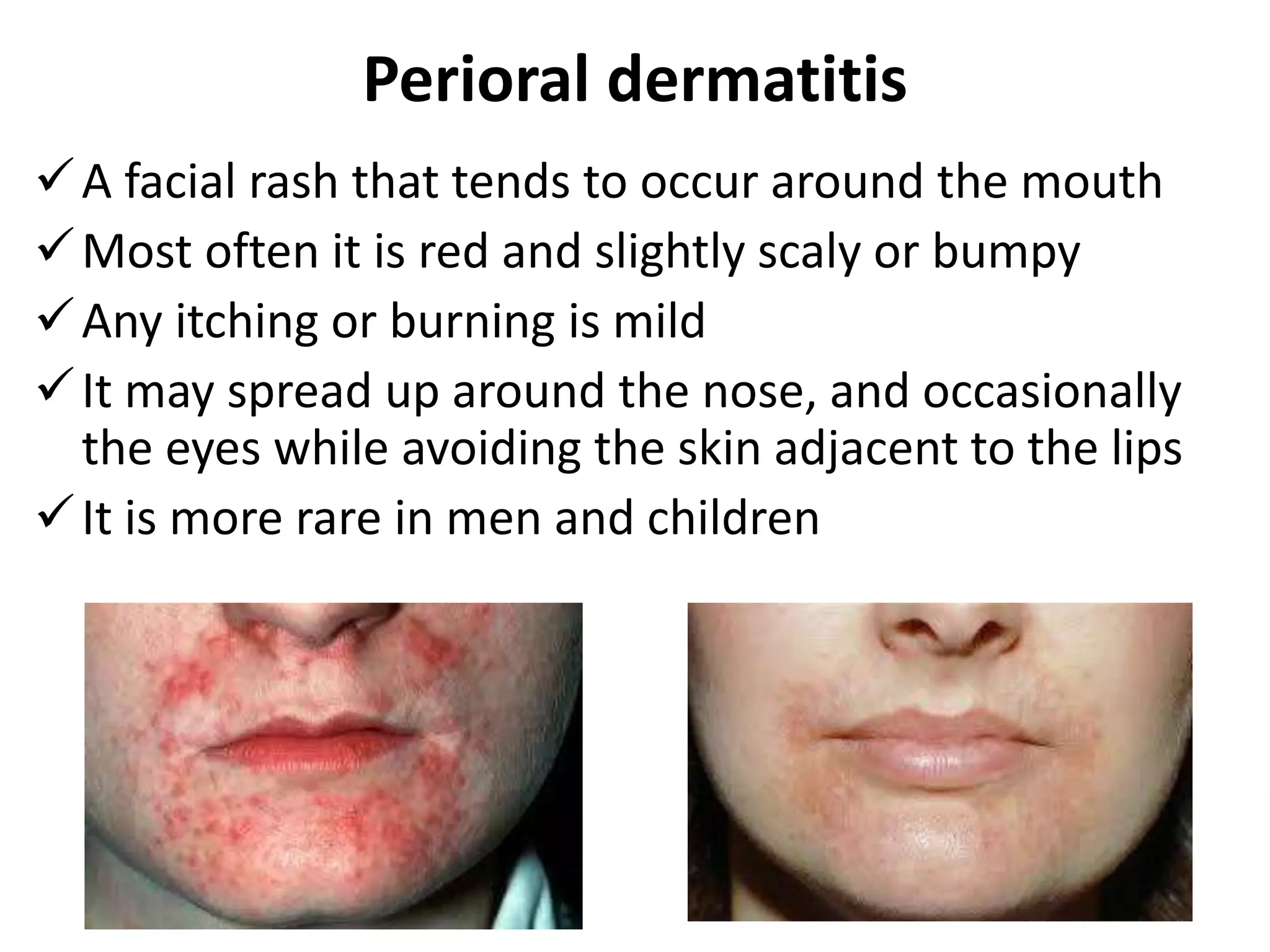Acne vulgaris....pptx