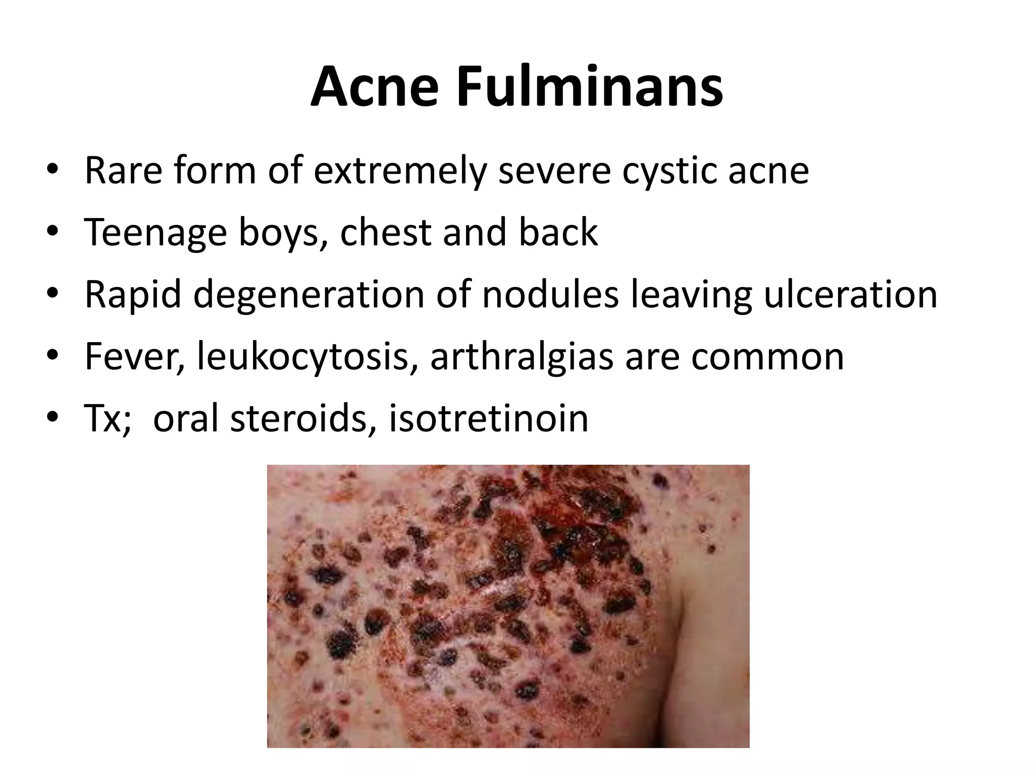 Acne vulgaris....pptx