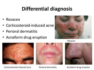 Acne vulgaris....pptx