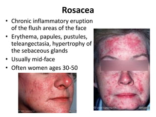 Acne vulgaris....pptx