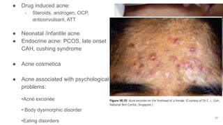 Acne vulgaris.pptx.pdf