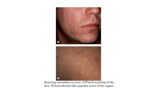 Acne vulgaris(EMBALABE) By: JUDE SSEGANE.pptx | Skin and Dermatology ...