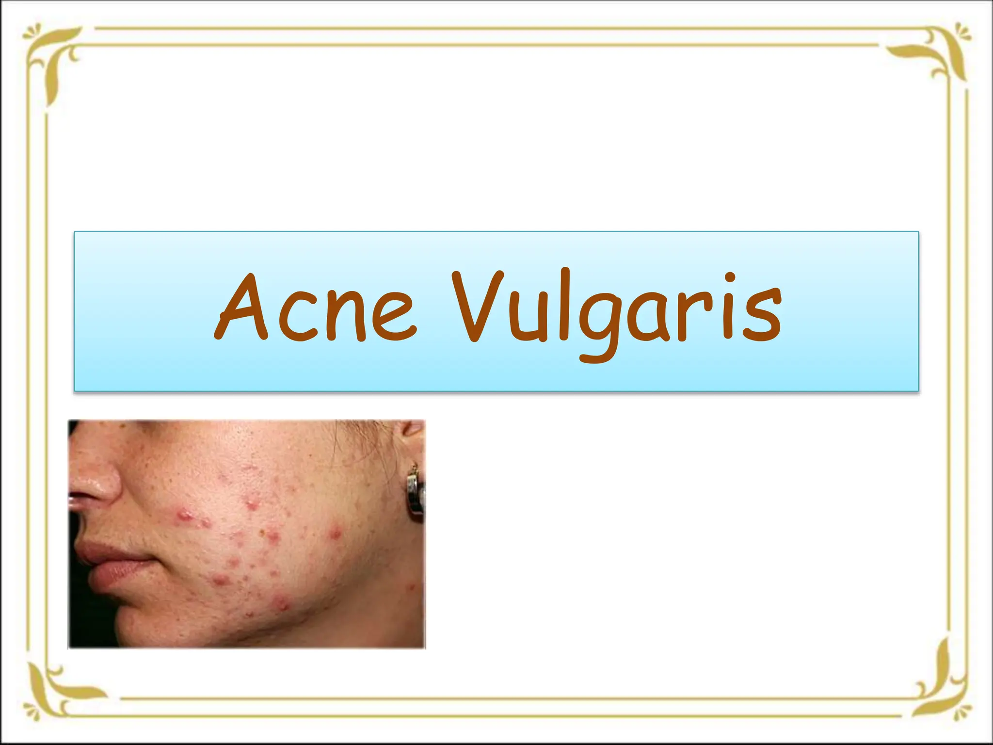 Acne vulgaris.pptx | Skin Care | Beauty