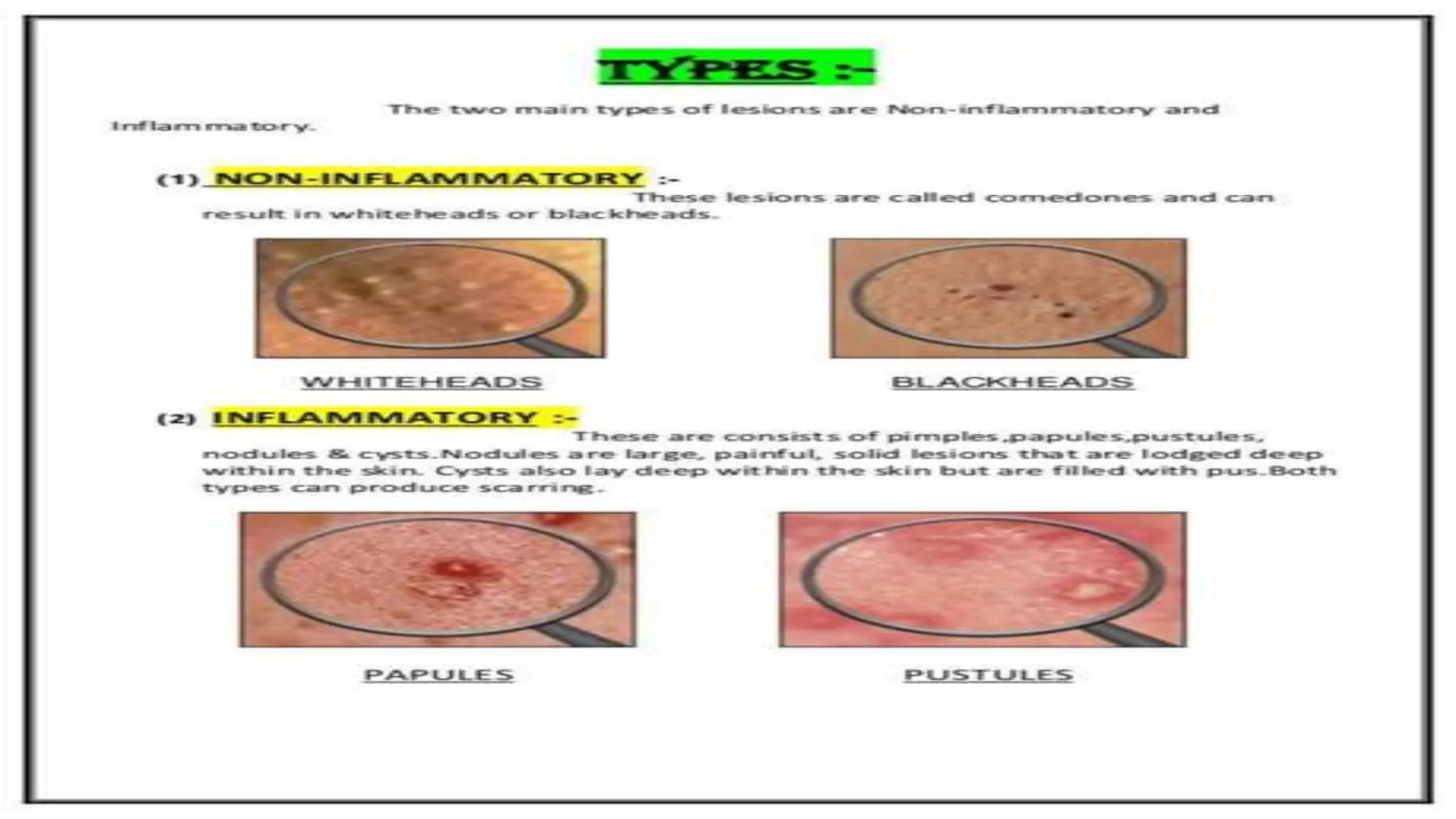 Acne Vulgaris skin infections and disorders.pptx