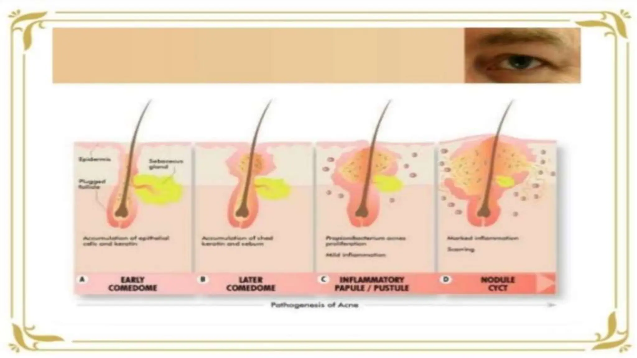 Acne Vulgaris skin infections and disorders.pptx