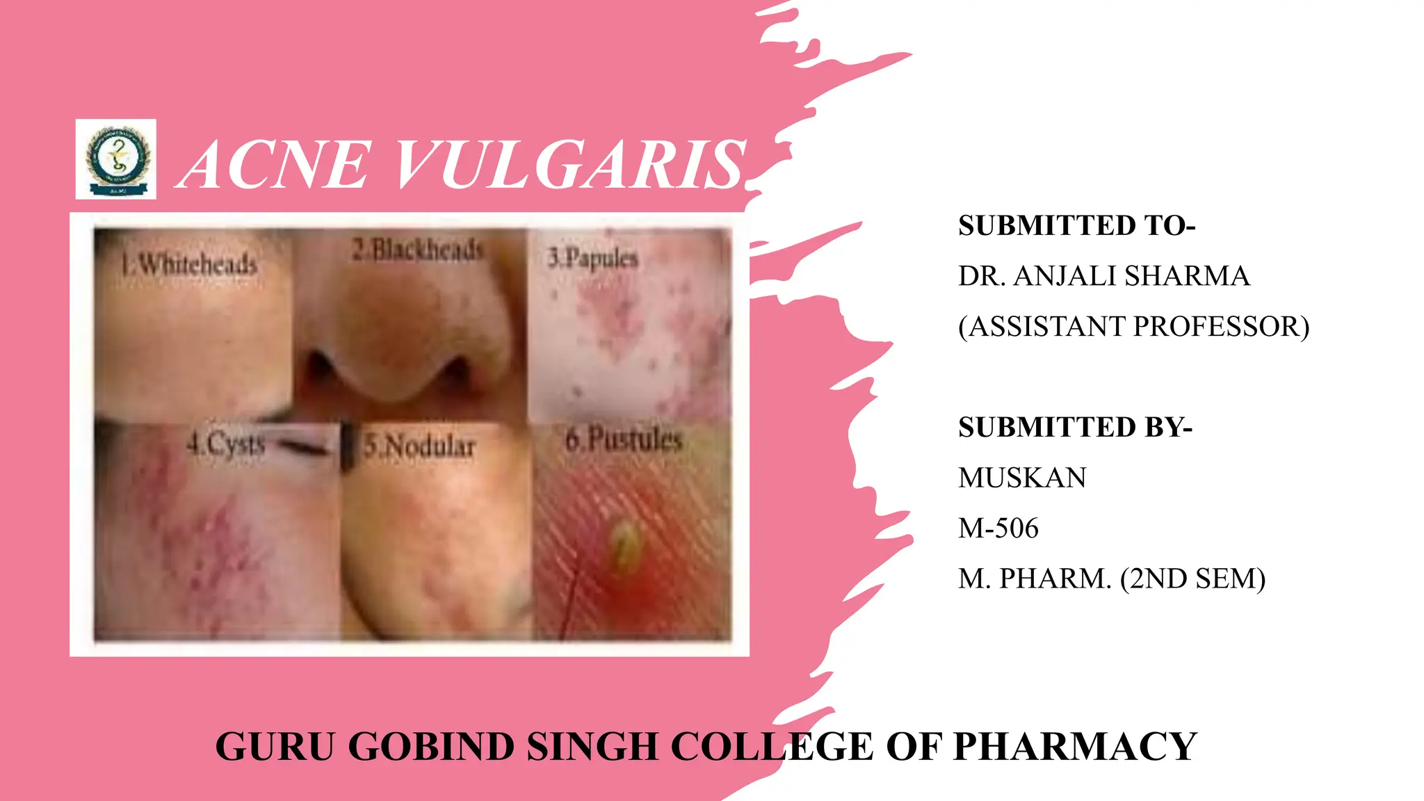 acne vulgaris -Mpharm (2nd semester) Cosmetics and cosmeceuticals | PPTX