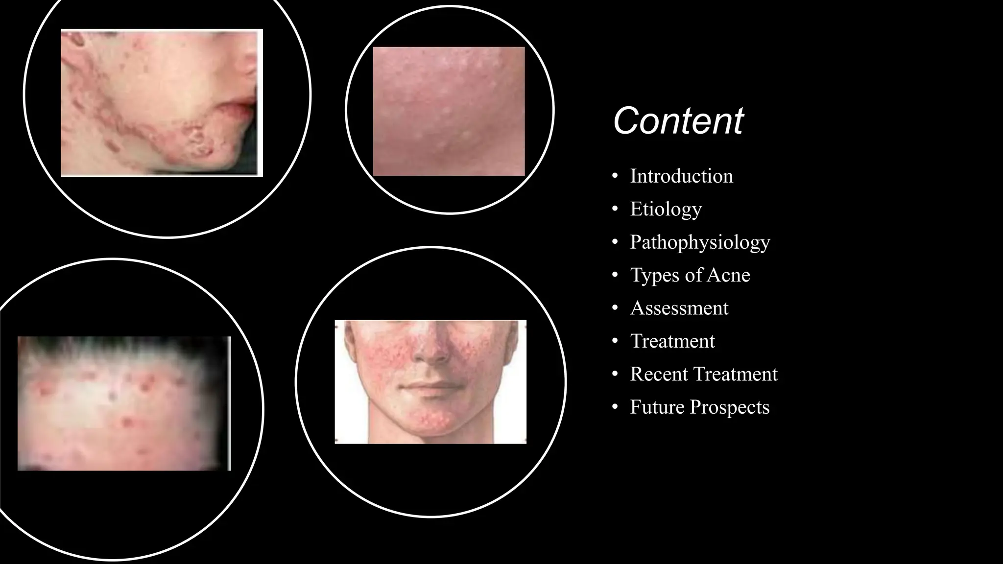 acne vulgaris -Mpharm (2nd semester) Cosmetics and cosmeceuticals | PPTX