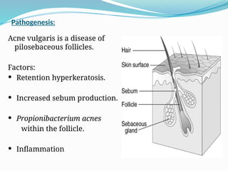 Acne Vulgaris is a chronic inflammatory disease of the pilosebaceous ...