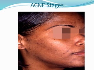 Acne Vulgaris is a chronic inflammatory disease of the pilosebaceous ...