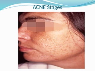 Acne Vulgaris is a chronic inflammatory disease of the pilosebaceous ...