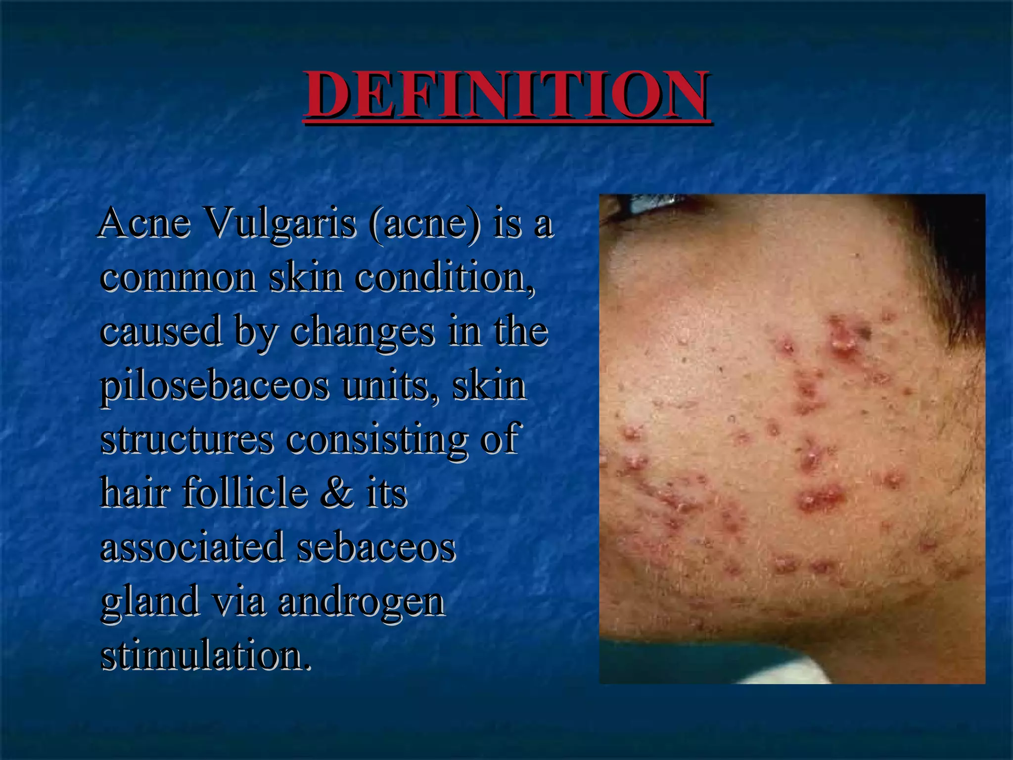 Acne vulgaris (60) | PPT