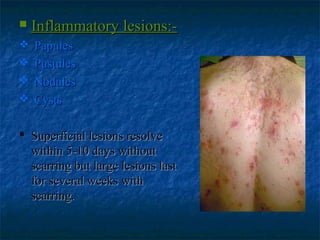 Acne vulgaris (60) | PPT