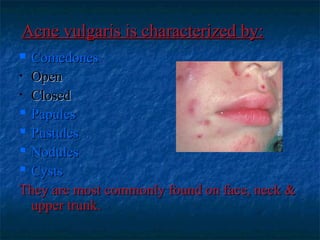 Acne vulgaris (60) | PPT