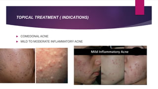 Acne vulgaris approach to topical treatment | PPTX
