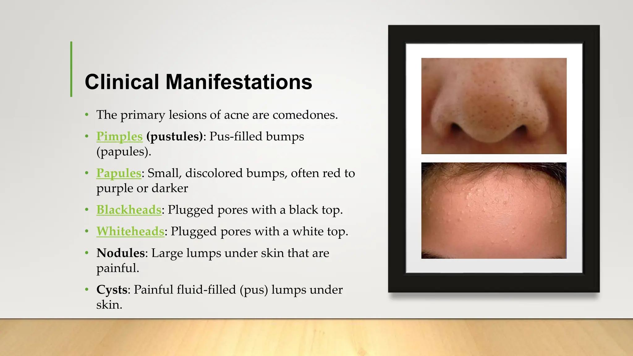 Acne Vulgaris or Acne by Sachin Dwivedi.pptx