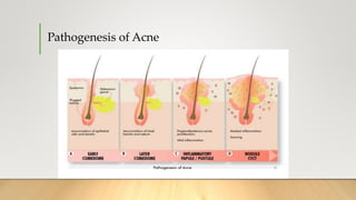 Acne Vulgaris or Acne by Sachin Dwivedi.pptx | Free Download