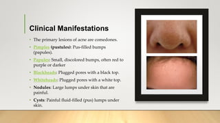 Acne Vulgaris or Acne by Sachin Dwivedi.pptx