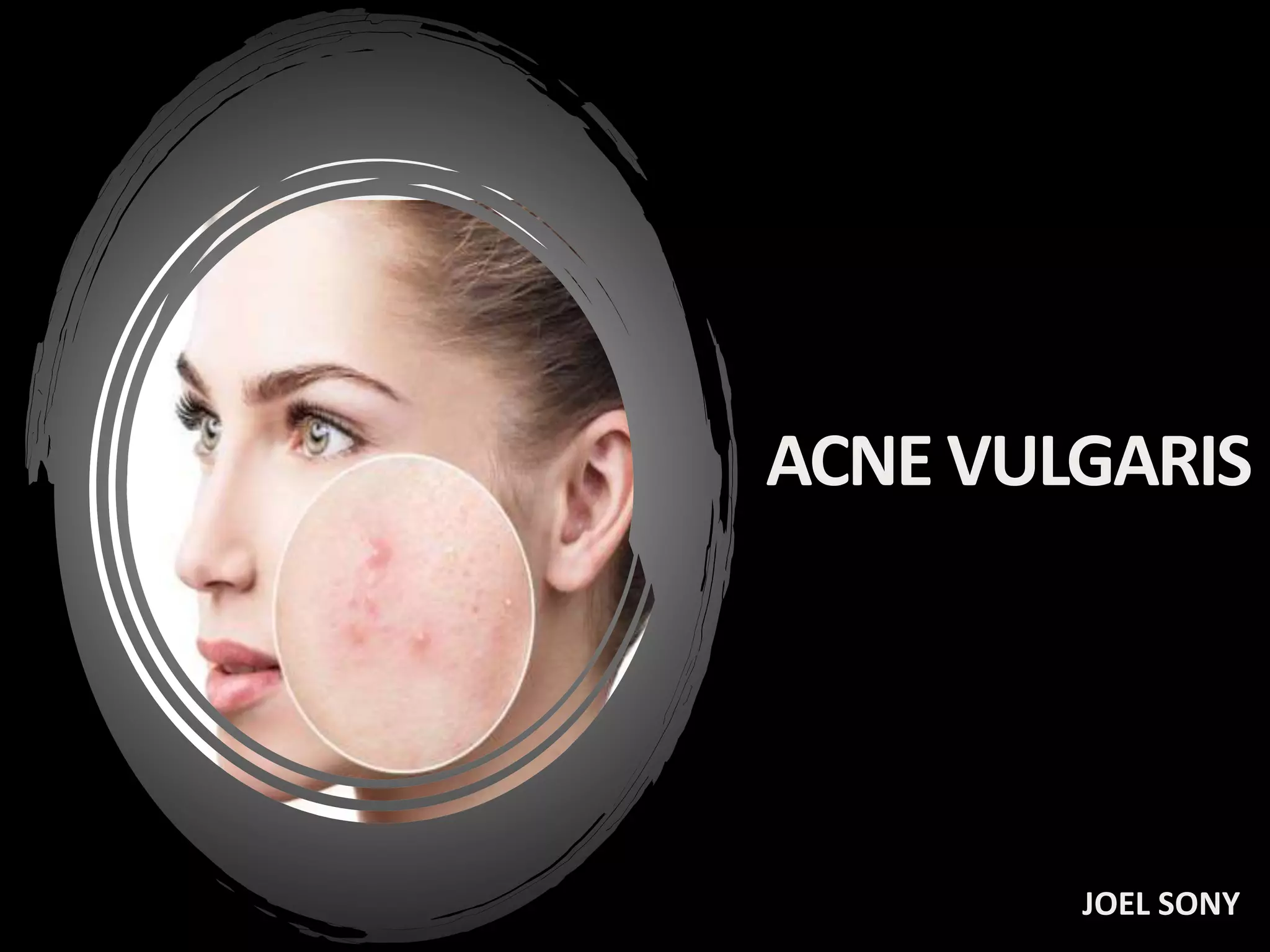Acne vulgaris dermatology ppt | PPTX