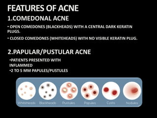 Acne vulgaris dermatology ppt | PPTX