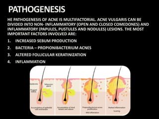 Acne vulgaris dermatology ppt | PPTX