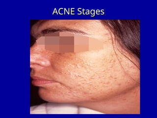 Acne Vulgaris is a chronic inflammatory disease of the pilosebaceous ...