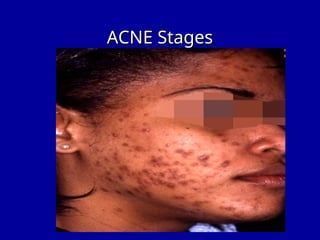 Acne Vulgaris is a chronic inflammatory disease of the pilosebaceous ...