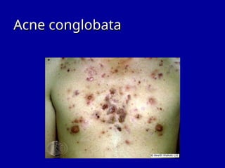 Acne Vulgaris is a chronic inflammatory disease of the pilosebaceous ...