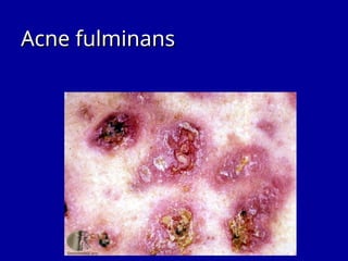 Acne Vulgaris is a chronic inflammatory disease of the pilosebaceous ...