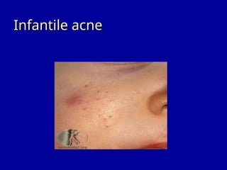 Acne Vulgaris is a chronic inflammatory disease of the pilosebaceous ...