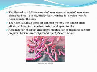 ACNE VULGARIS SlideShare M410-1.pptx
