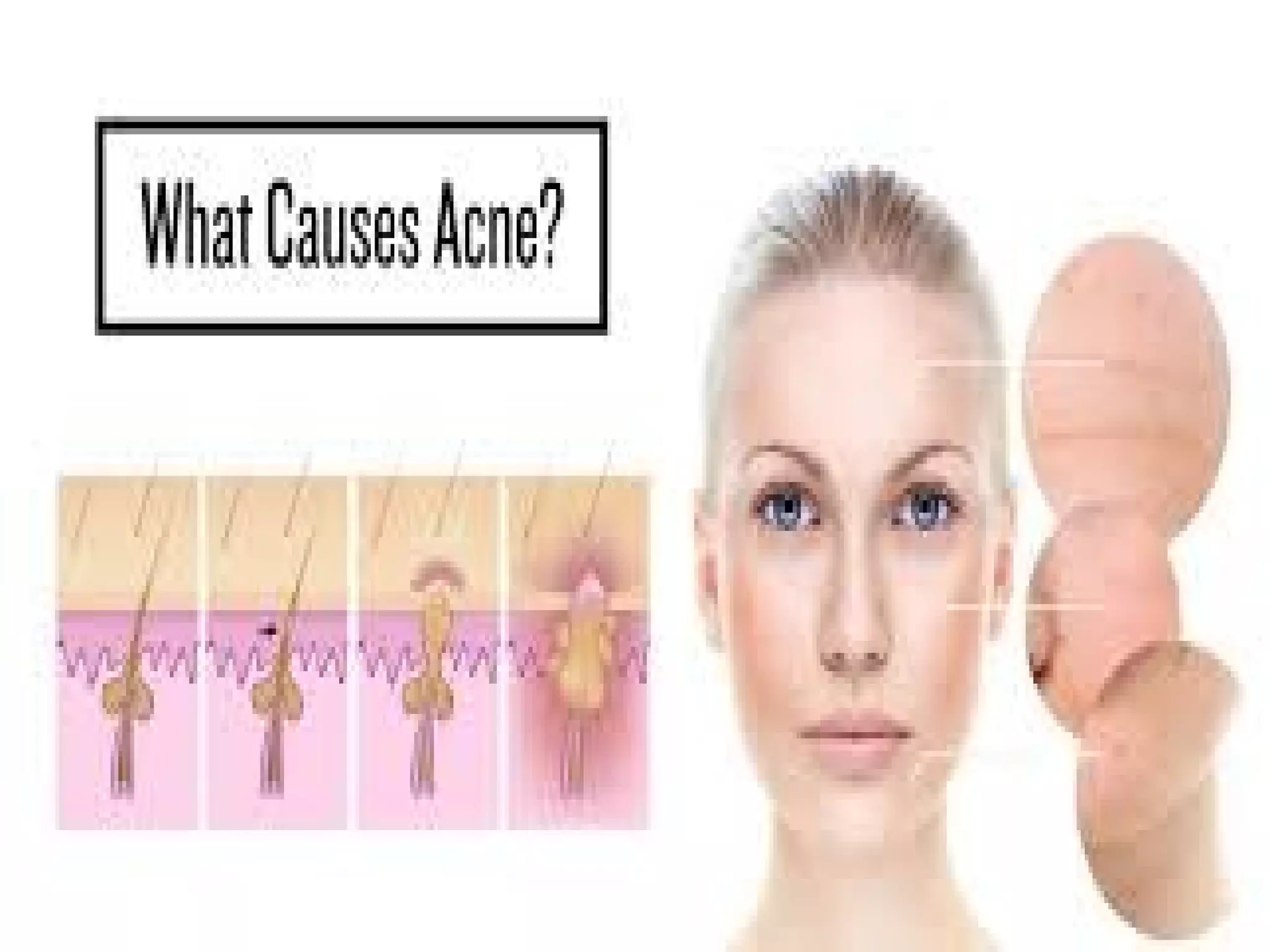 Acne vulgarispresentation | PPT