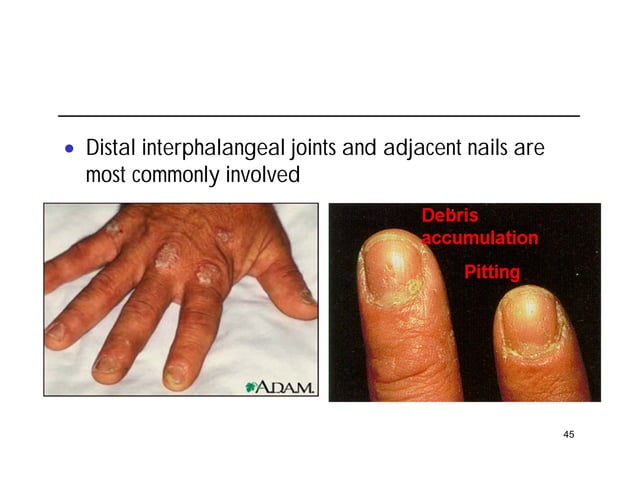 Acne vulgaris, psoriasis and atopic dermatitis handout_2.pdf | Skin ...