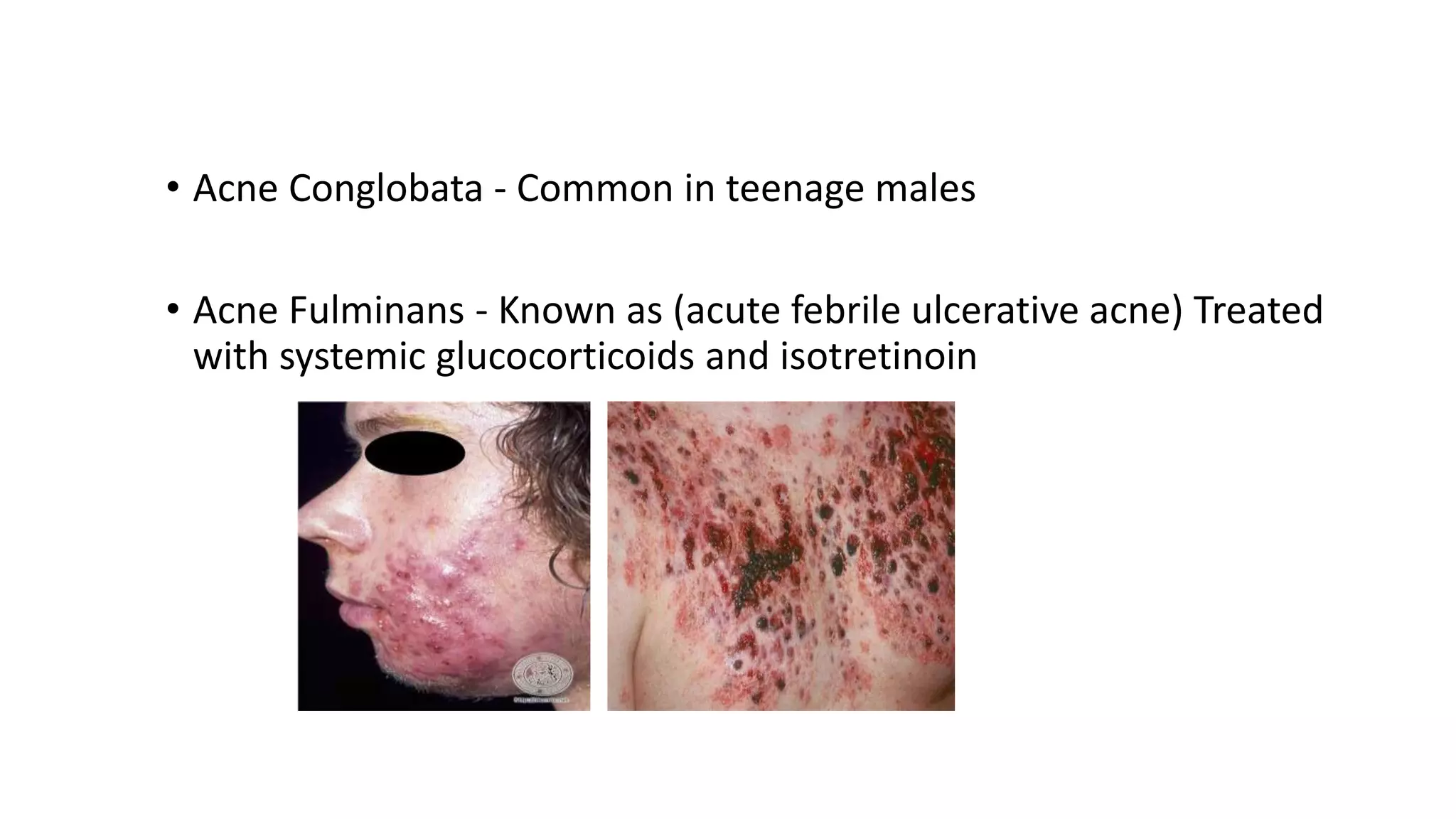 Acne vulgaris | PPTX